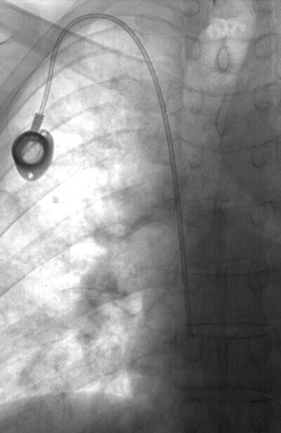 Venous Access: Port Placement • Interventional Care